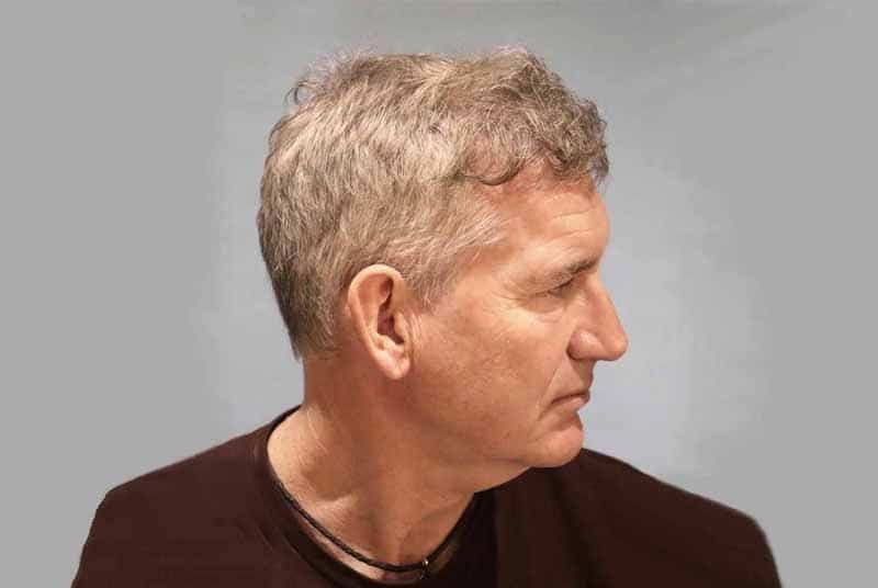 Simon Pringle | Results | Farjo Hair Institute