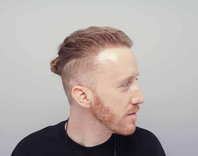 Daley, Singer/Songwriter | Results | Farjo Hair Institute