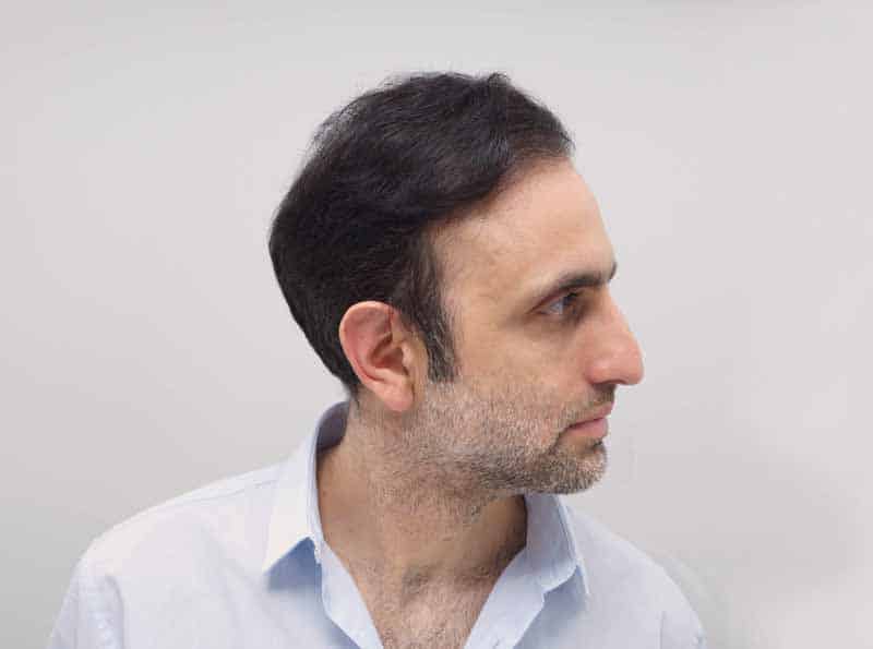 Tim Samuels, Broadcaster | Results | Farjo Hair Institute