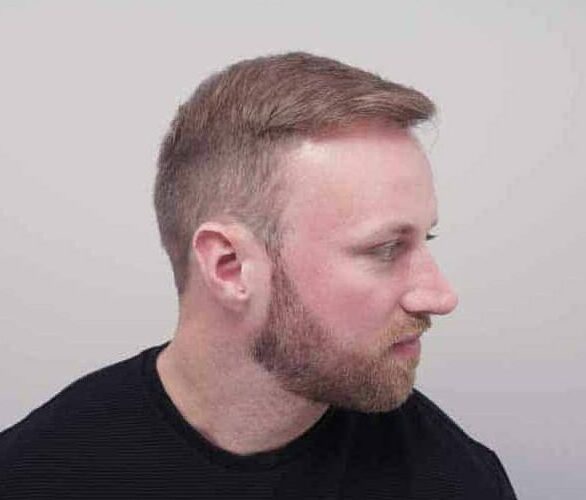 Alex Aitken | Results | Farjo Hair Institute