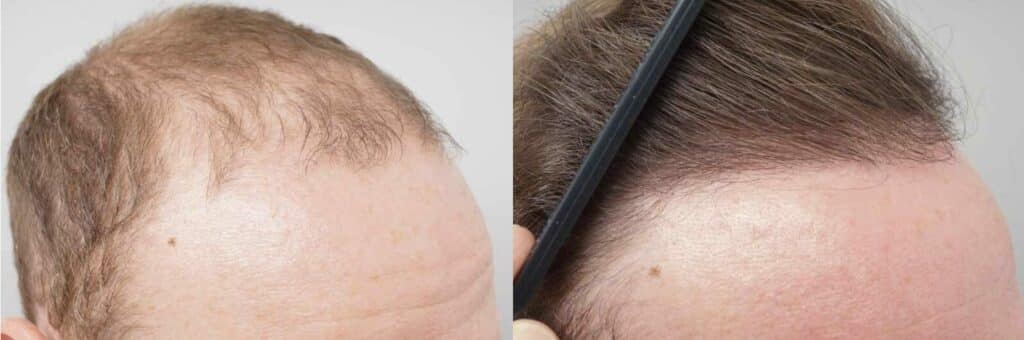 George Groves Hair Transplant at Farjo Hair Institute George Groves ...
