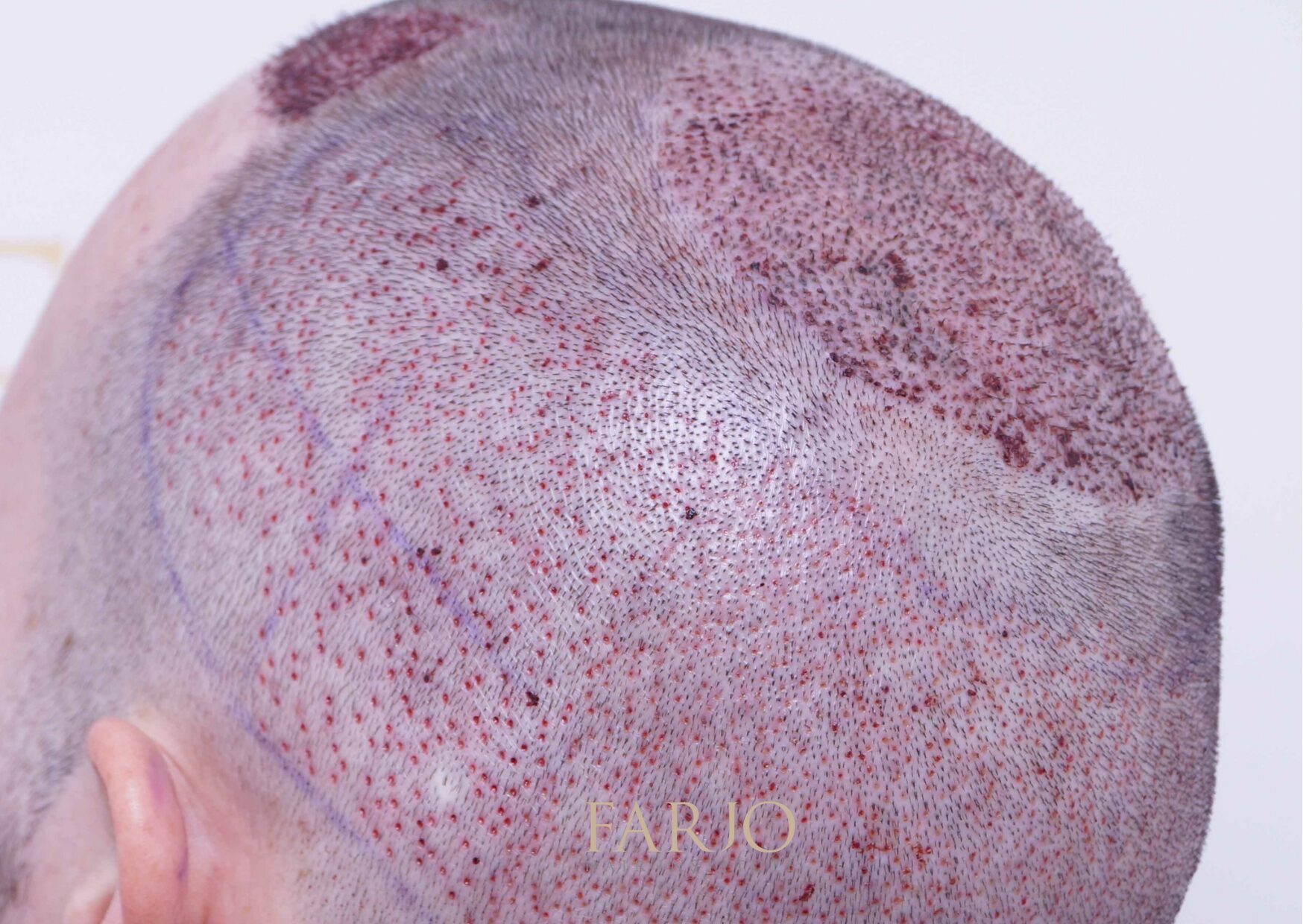 Hair Transplant Aftercare Guide | Farjo Clinic UK