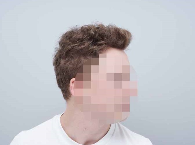 Ryan Johnson | Results | Farjo Hair Institute