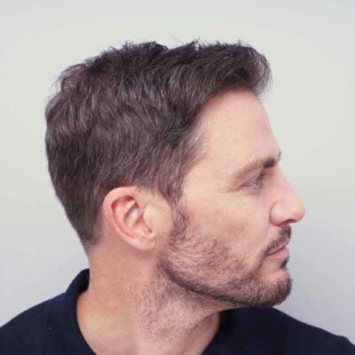Matt Peacock, Model | Results | Farjo Hair Institute