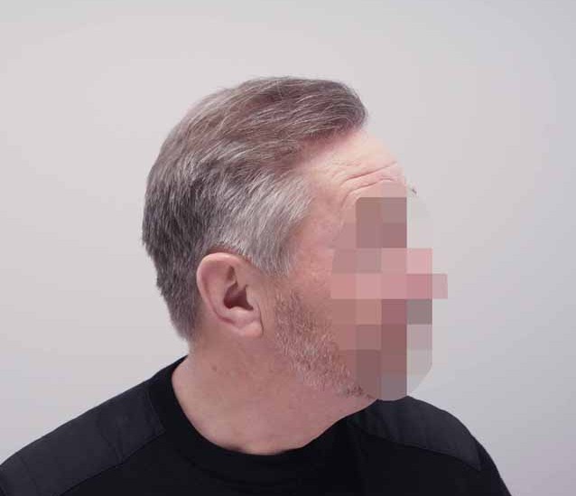 Des Kenilworth | Results | Farjo Hair Institute