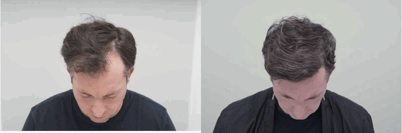 Robbie Fowler Hair Transplant | Celebrity Hair Transplants