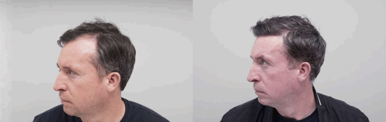 Robbie Fowler Hair Transplant | Celebrity Hair Transplants