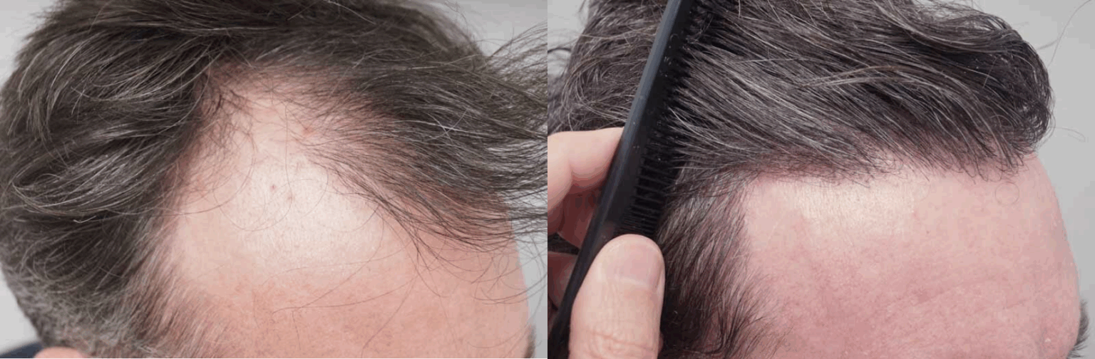 Robbie Fowler Hair Transplant | Celebrity Hair Transplants