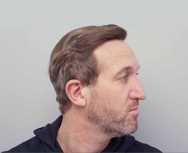 Ross Kenyon | Results | Farjo Hair Institute