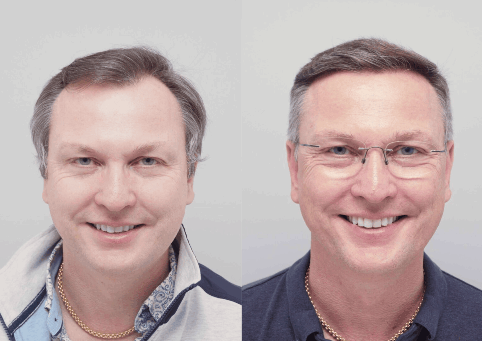 Stephen Dixon Hair Transplant